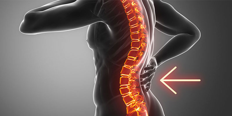 Lordose: o que é, causas e tratamento - Dr. Edgar Utino