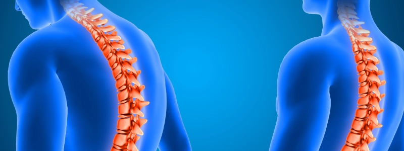 Cifose: o que é, causas e tratamento - Dr. Edgar Utino