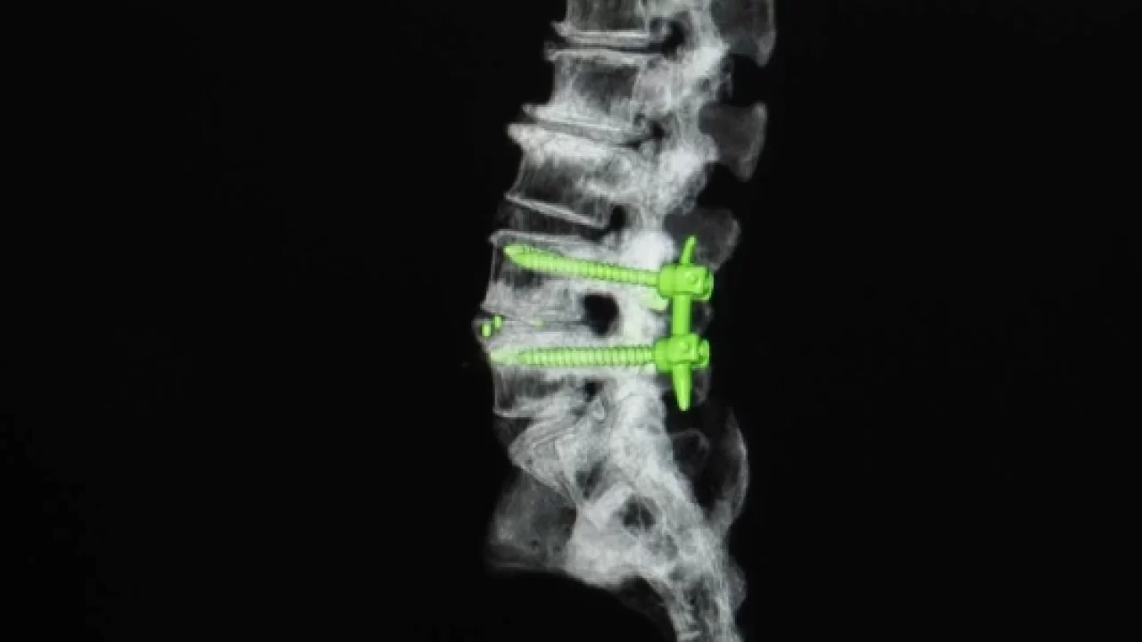 Ressonancia Magnetica Da Anatomia Da Coluna Lombar